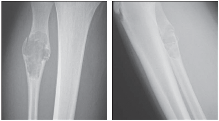 Pathologic Fracture X Ray